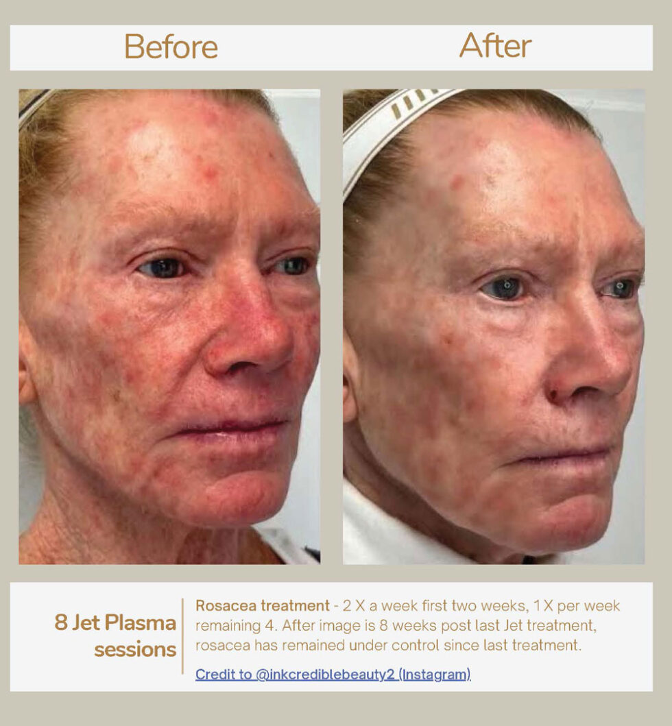 Jet Plasma - $400 - Nice Skin Beverly Hills